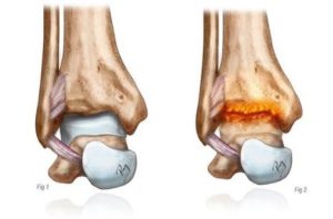 L'arthrose de la cheville - Centre de Chirurgie Orthopédique et Sportive