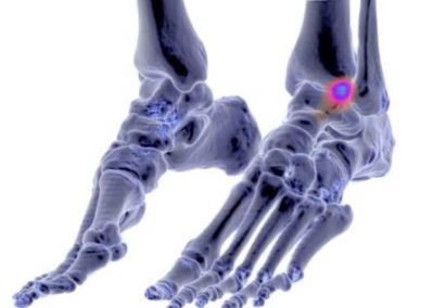 Lésion ostéochondrale du dôme Talien - Centre de Chirurgie Orthopédique ...