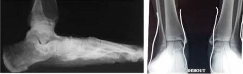 Le pied plat - Centre de Chirurgie Orthopédique et Sportive