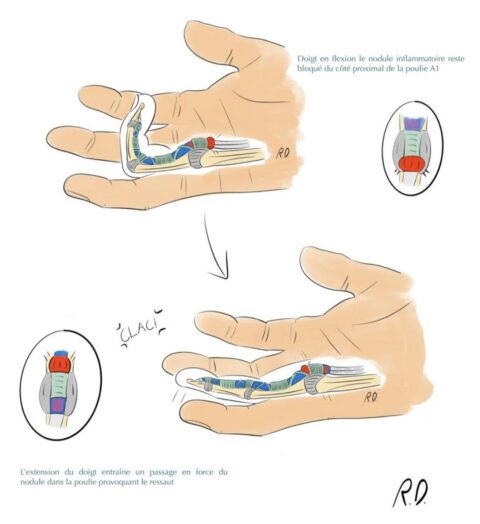 Doigt à ressaut - Centre de Chirurgie Orthopédique et Sportive