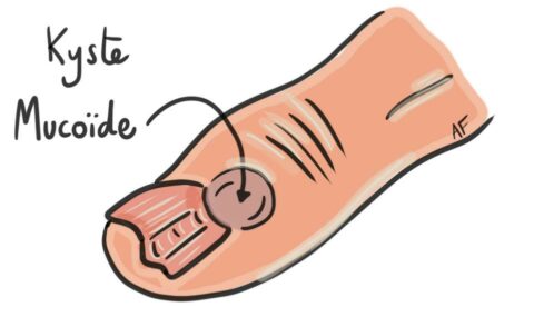 Le kyste mucoïde - Centre de Chirurgie Orthopédique et Sportive